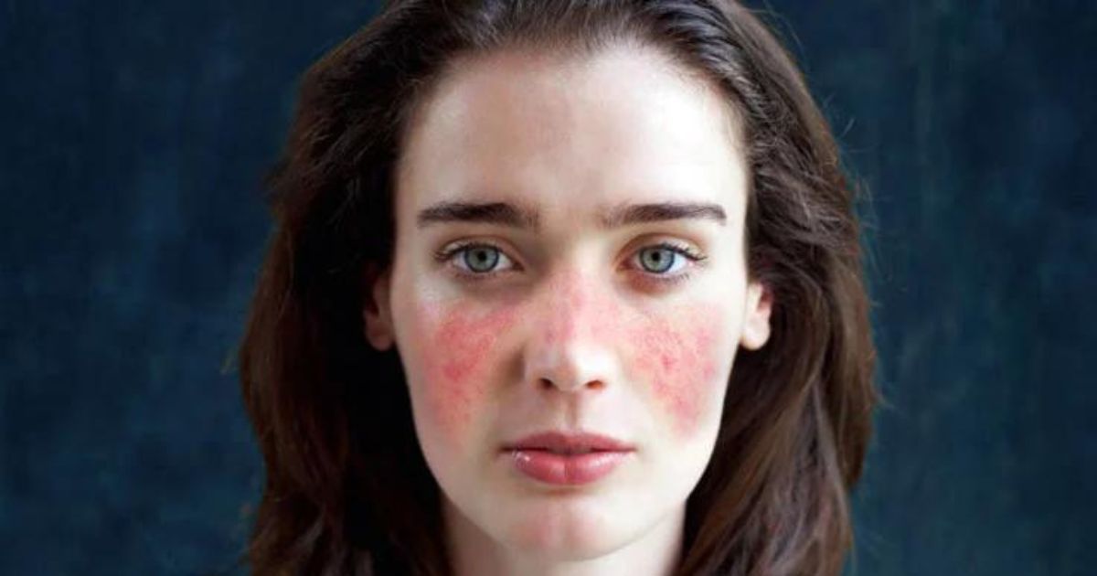 Día Mundial del Lupus: por qué se conmemora este 10 de mayo