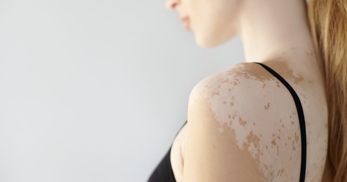 Día Mundial del Vitiligo: por qué se conmemora hoy, 25 de junio